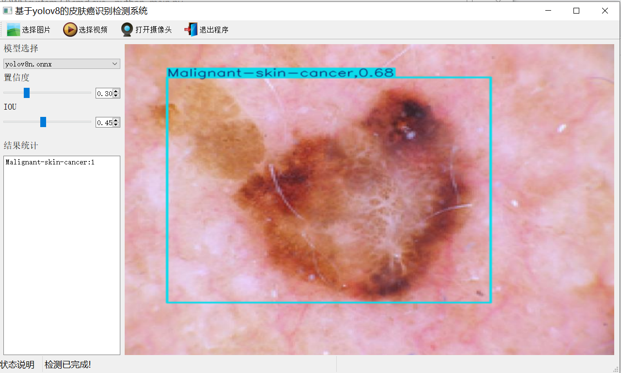 基于yolov8的皮肤癌检测系统python源码+onnx模型+评估指标曲线+精美GUI界面-腾讯云开发者社区-腾讯云