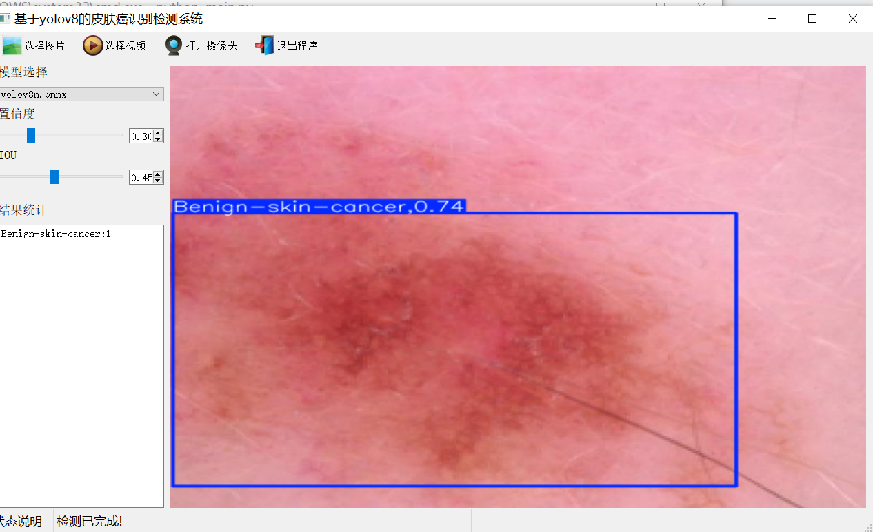 基于yolov8的皮肤癌检测系统python源码+onnx模型+评估指标曲线+精美GUI界面-腾讯云开发者社区-腾讯云