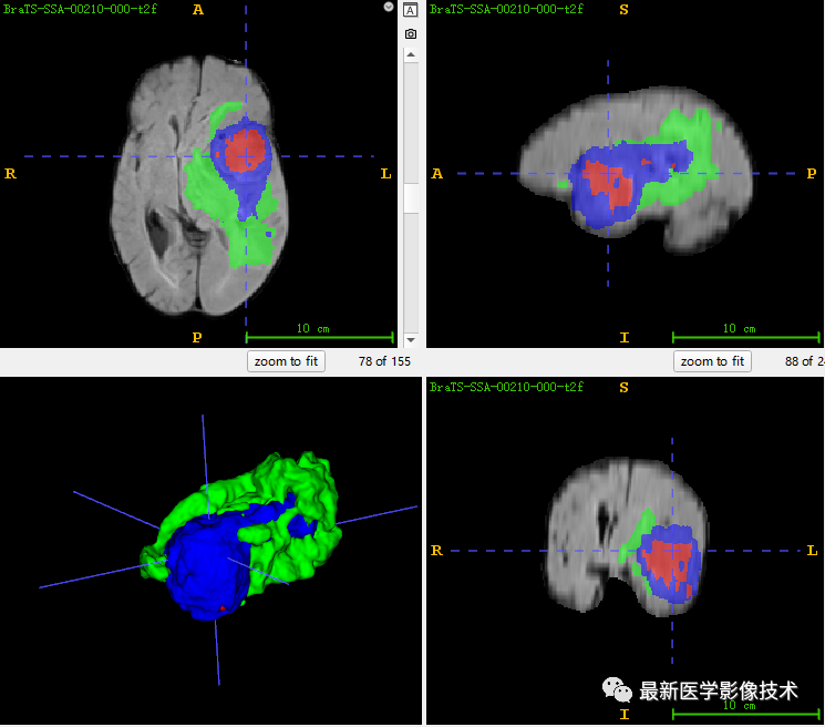 BraTS2023-SSA——BraTS2023撒哈拉以南非洲成人胶质瘤分割挑战-腾讯云开发者社区-腾讯云