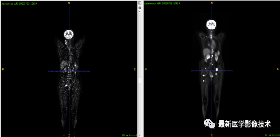 Ultra-low Dose PET2022——超低剂量PET成像挑战-腾讯云开发者社区-腾讯云